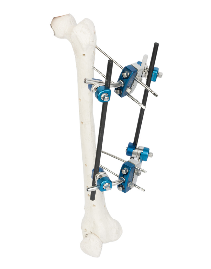 Lower Limbs Orthopedic External Fixator 30 Degree Rod Class III from ...