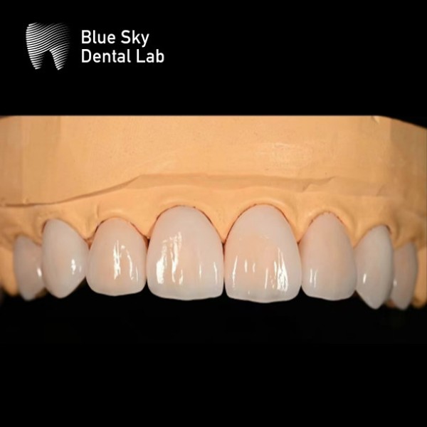 Quality Lightweight Rectangular Dental Veneer Cases With Passive Fitting Only 0.3mm for sale