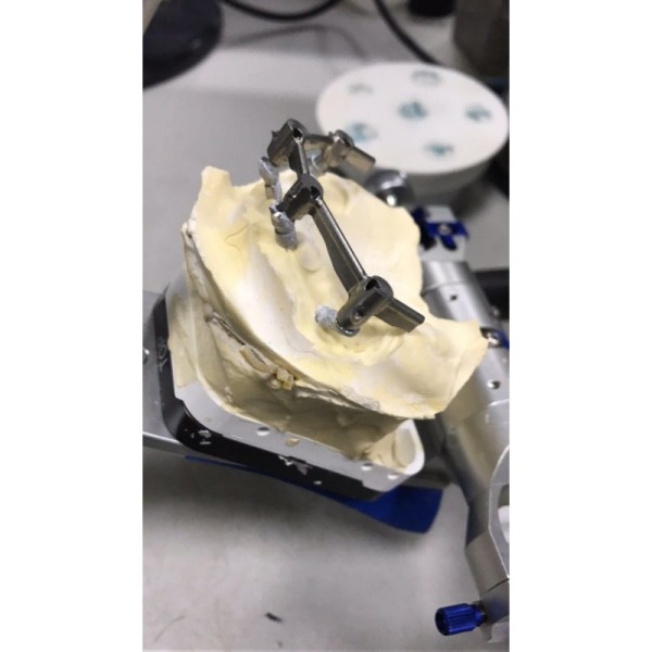 Quality Titanium Implant and Implant Bar for sale