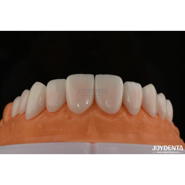 Quality Optimal Patient Comfort With Porcelain Veneers Biocompatible And Gentle On Oral Tissues for sale