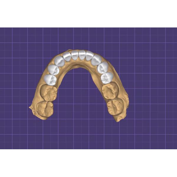 Quality Precision Fit Digital Wax Up Dental Study Model with Durable and Biocompatible for sale