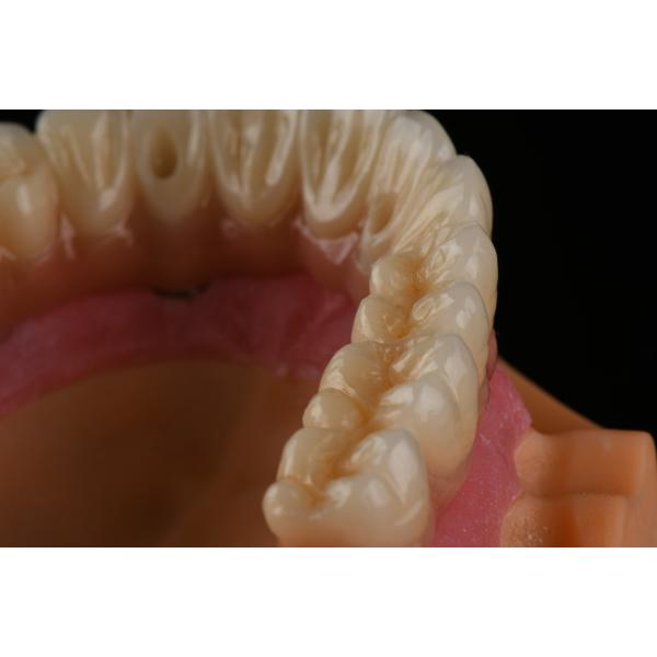 Quality Roughened Surface Titanium Dental Implants Surgery For Front Tooth Replacement for sale