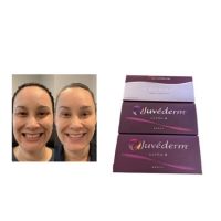 Quality Juvederm Injectable dermal filler Juvederm Ultra3 Ultra4 Voluma for sale