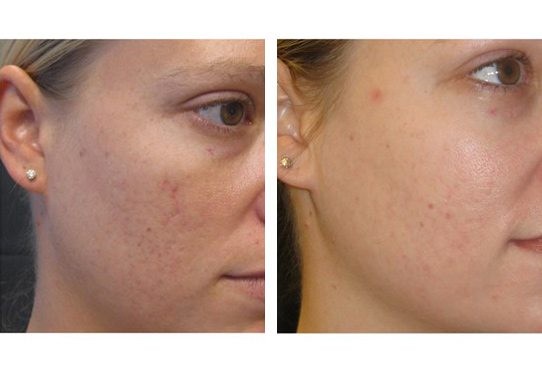 Quality Skin Rejuvenation Water Diamond Microdermabrasion Machine for sale