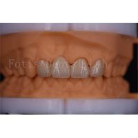 Quality FDA Certified Digital Crowns Bridge Dentrues Design Customizable Size for sale