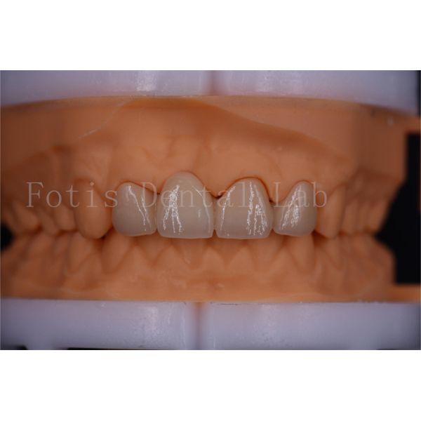 Quality FDA Certified Digital Crowns Bridge Dentrues Design  Customizable Size for sale