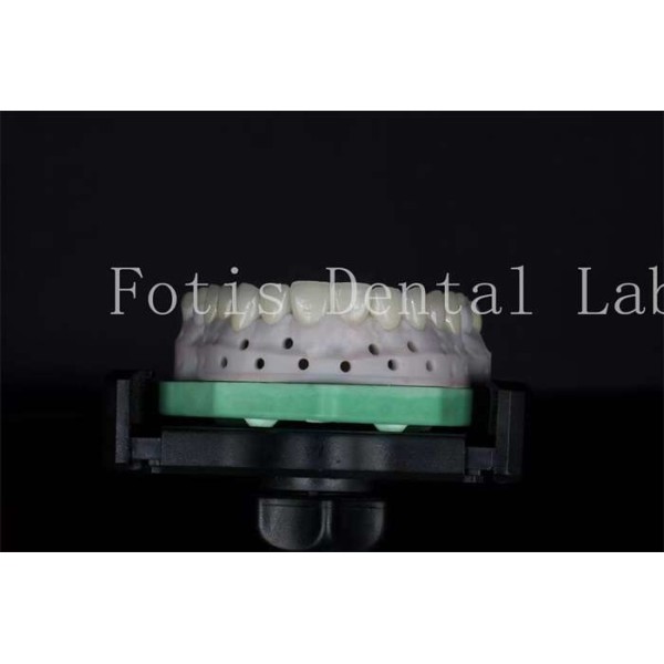 Quality High Strength Dental Lab Veneers Customizable For Natural Smiles for sale