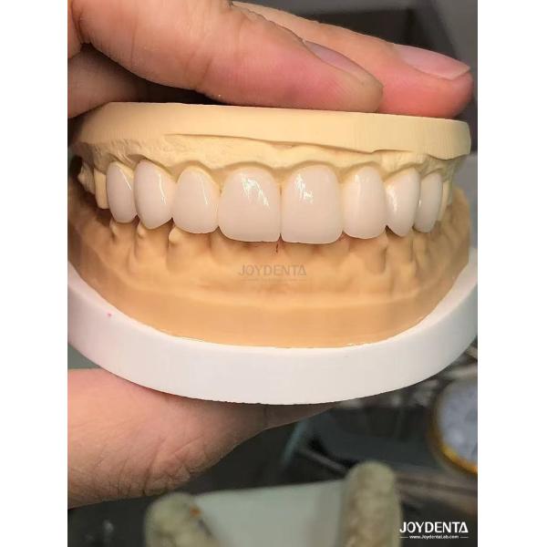 Quality Customized Shades To Match Natural Teeth Biocompatible And Stain Resistant Dental Veneers for sale