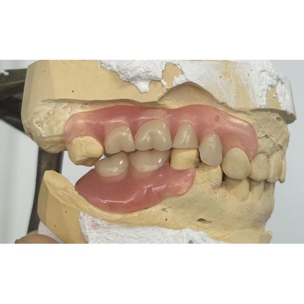 Quality Removable Denture with Lingual Bar Retention for High Precision Fit and for sale