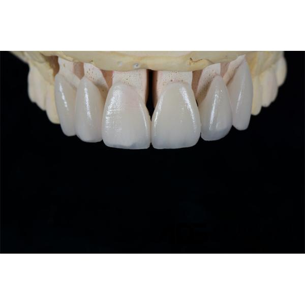 Quality Dental Natural Porcelain Teeth Veneers Feldspathic Veneer 0.5mm-0.7mm for sale