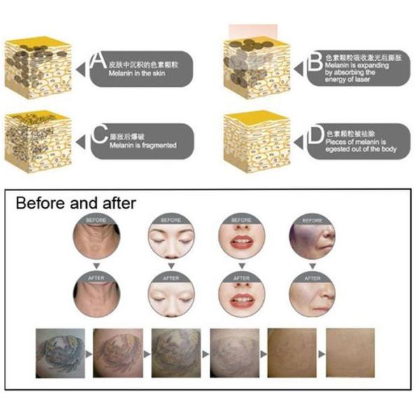 Quality Alexandrite Melasma Picosecond Laser Machine 755nm Tattoo Laser Equipment for sale