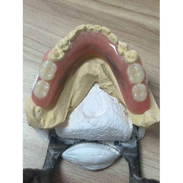 Quality Removable Denture with Lingual Bar Retention for High Precision Fit and for sale