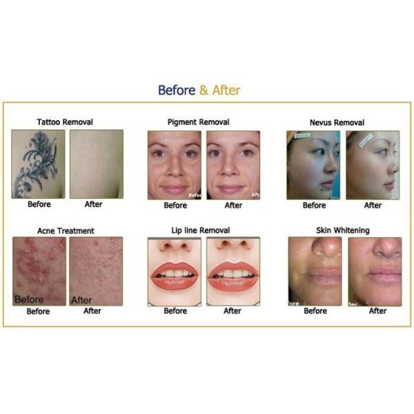 Quality Portable Blackhead Removal Picosecond Laser Machine 1064nm Tattoo Eraser for sale