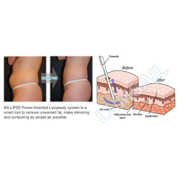 Quality Liposuction Cavitation Slimming Machine Power Assisted for sale