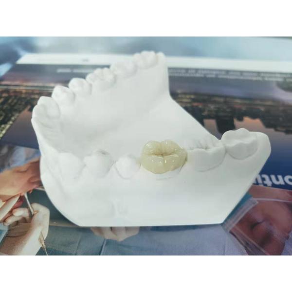 Quality Durable FDA All-Ceramic Dental Crown Veneer Inlay Onlay Similar for sale