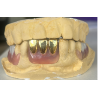 Quality Gold Material Dental Crown with Denture Attachment for Dental Restoration for sale