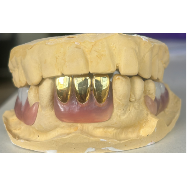 Quality Gold Material Dental Crown with Denture Attachment for Dental Restoration for sale