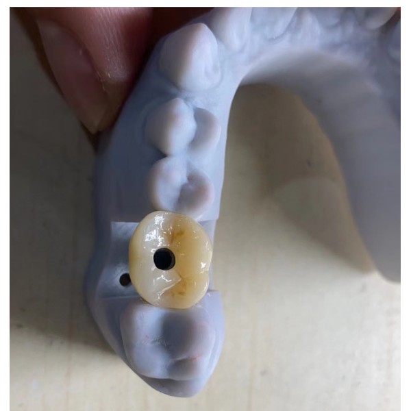 Quality High Precision Implant Supported Crown Stable And Easy Maintenance for sale