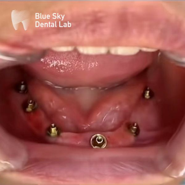 Quality Nature Design Dental Implant Case Implant Operation Cases For Multiple Choices for sale