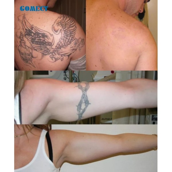 Quality 2000W Picosecond Laser Tattoo Removal Machine for sale