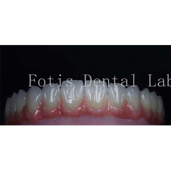 Quality Smooth Surface Cosmetic Tooth Coverings Natural Porcelain Veneers Customizable for sale