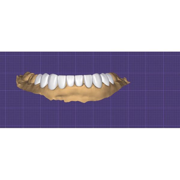 Quality Precision Fit Digital Wax Up Dental Study Model with Durable and Biocompatible for sale