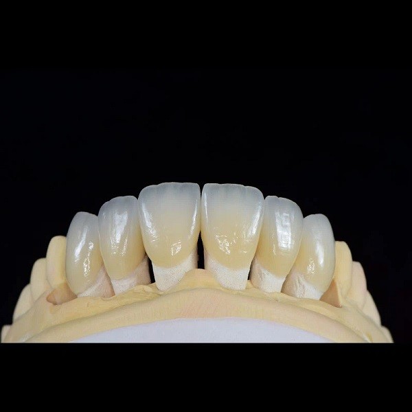Quality Feldspathic Porcelain Dental Veneer Layered Zirconia Fabrication for sale