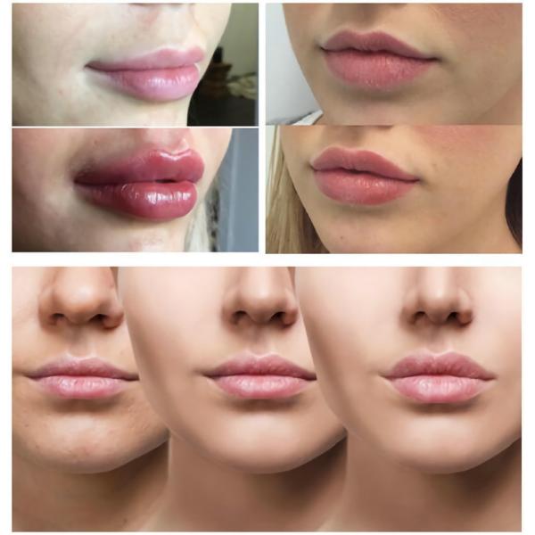 Quality Smooth Lines / Plump Lips With Hyaluronic Acid Injectable Filler 1ml 2ml 5ml for sale