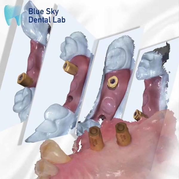 Quality Scan Body  All In One Dental Healing Capsule Blue Sky Implant System for sale