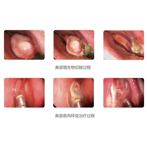 Quality Low Temperature RF Plasma System Cutting Perforation Ablation Cryosurgery Unit for sale