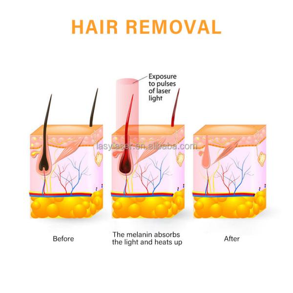 Quality Rechargeable VCA IPL Hair Removal Machine 808nm Ellipse IPL Machine for sale