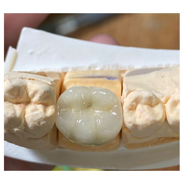 Quality Precise Esthetic Strong Dental PFM Porcelain Fused To Metal Crown In Dentistry for sale