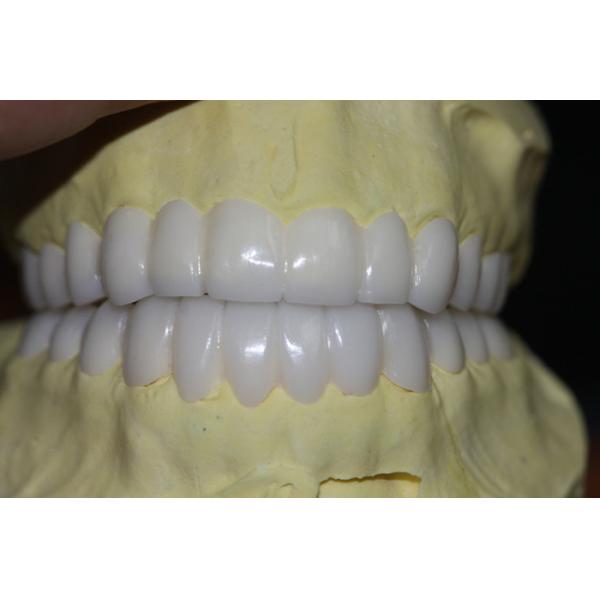 Quality Temporary PFM Dental Crown for sale
