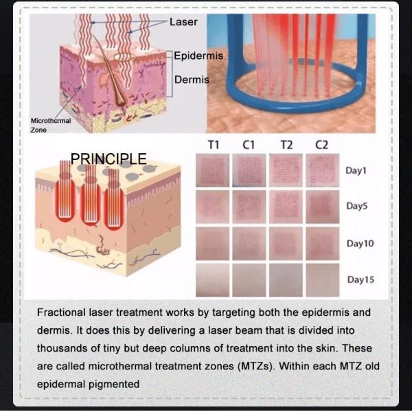 Quality 635nm Vaginal Co2 Laser Resurfacing Machine , Ultrapulse Vigina Tightening for sale