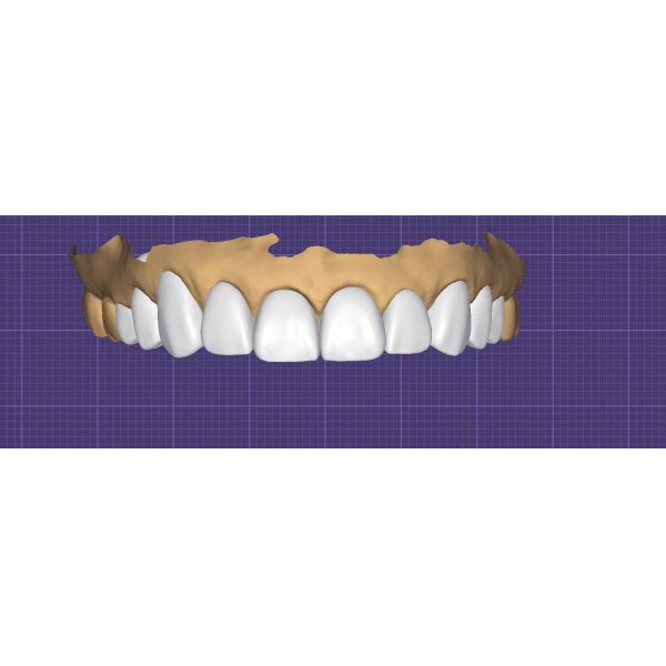 Quality Precision Fit Digital Wax Up Dental Study Model with Durable and Biocompatible for sale