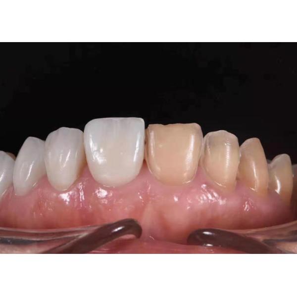Quality 0.3MM Whitening Ceramic Dental Crown To Replace Unhealthy Teeth for sale