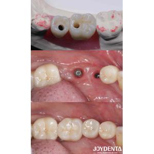 Quality Cylindrical All On 4 Titanium Dental Implants 10-16mm Length Hex Connection for sale