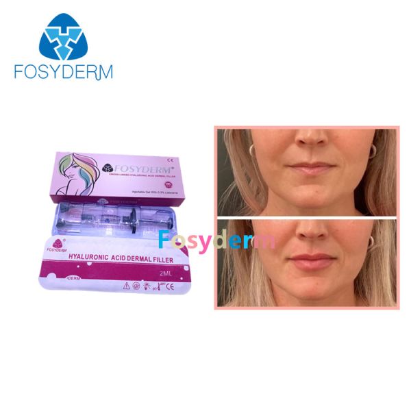 Quality Fosyderm 2ml Dermal Lip Fillers Hyaluronic Acid Lip Enhancement Injection Derm Line for sale