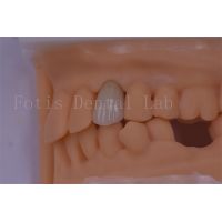 Quality 3 Shape/Exo Design Digital Dental Crowns Better Fit And Less Discomfort for sale