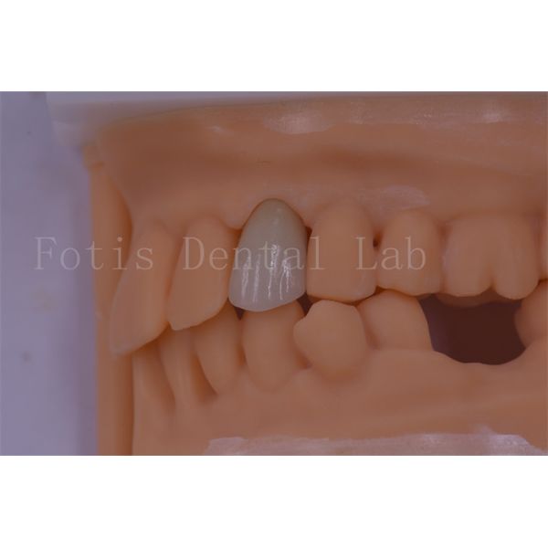 Quality 3 Shape/Exo Design Digital Dental Crowns Better Fit And Less Discomfort for sale