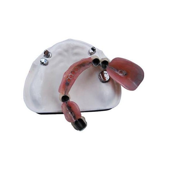 Quality Telescope crowns and denture for sale