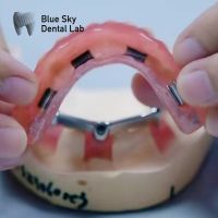 Quality Acrylic Denture Dental Titanium Bar With Attachments Silver And Gold for sale