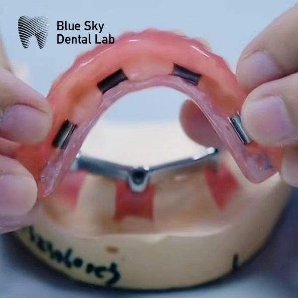 Quality Acrylic Denture Dental Titanium Bar With Attachments Silver And Gold for sale