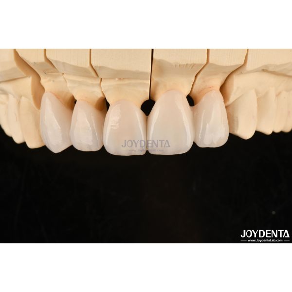 Quality Highly Customizable Layered Zirconia Dental Crowns And Bridges Long Lasting Solution for sale