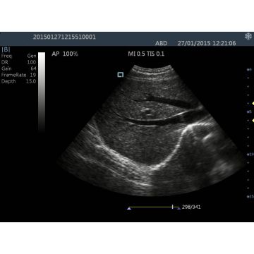 Quality Portable Ultrasound Scanner Color Doppler Machine With 15 Inch LCD Monitor for sale