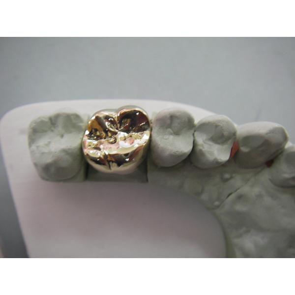 Quality Full Metal PFM Dental Crown Bridge High Tech Biological Material for sale