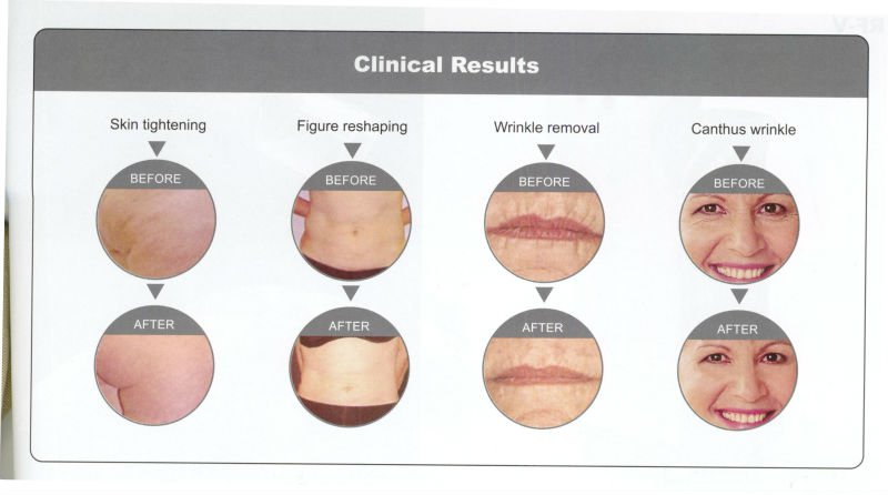 rf face skin tight machine