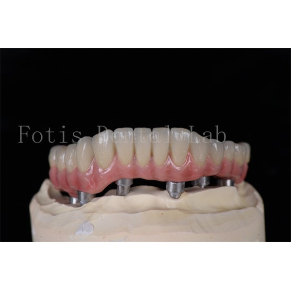 Quality Minimally Invasive Same Day All On 4 All On 6 Implants Natural Looking Easy To Clean for sale