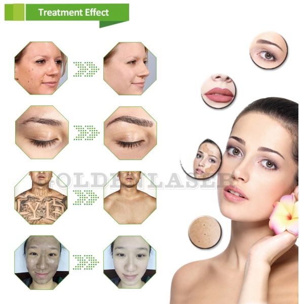 Quality Experience Smooth and Hair-Free Skin with Diode Laser Hair Removal Machine for sale