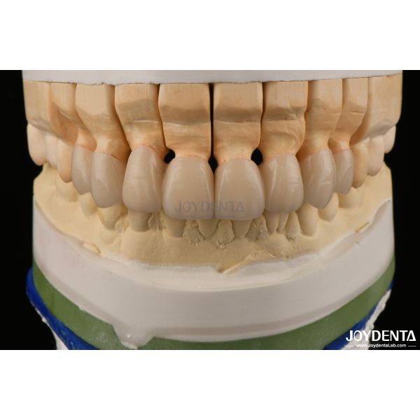 Quality High Translucency Layered Zirconia Crowns Bridges Dental Restorations lifelike appearance for sale